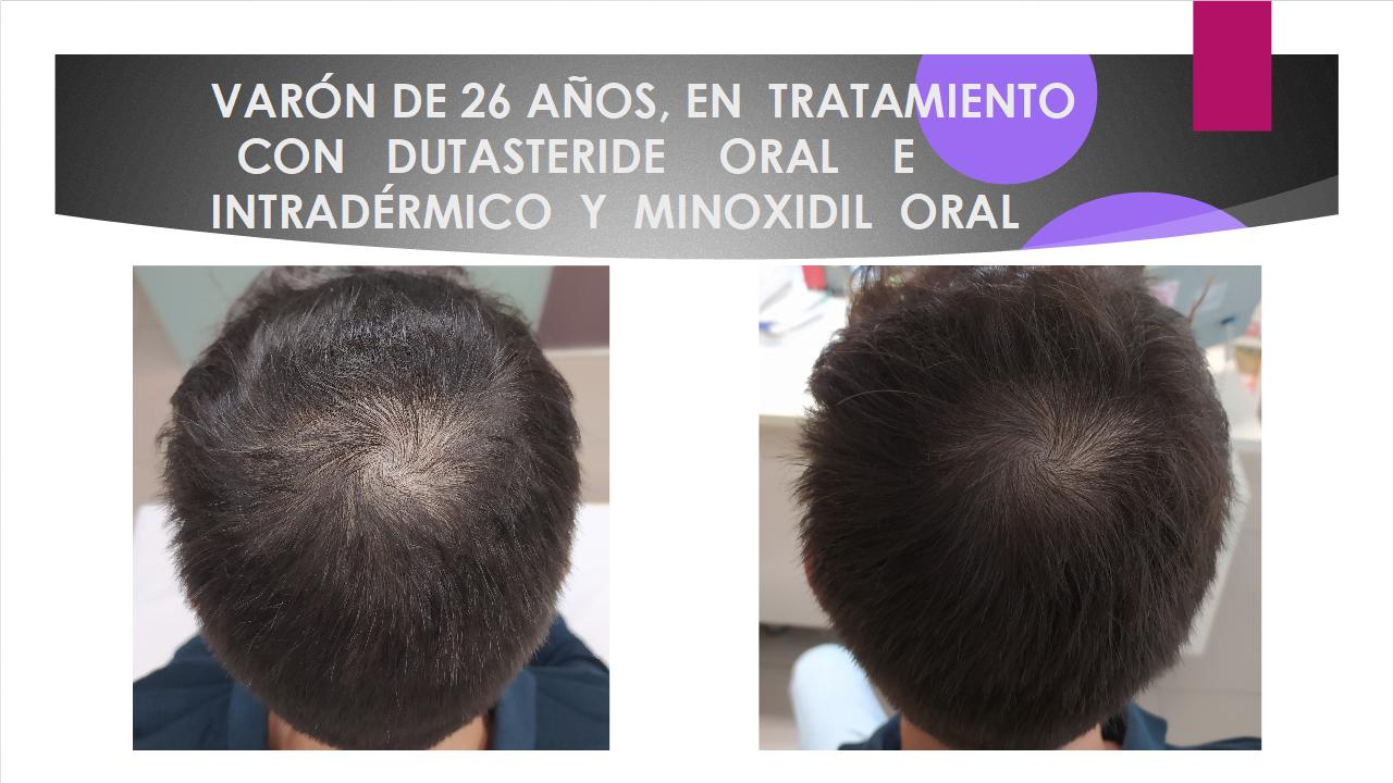 DERMABIA - Mesoterapia capilar con microinyecciones de Dutasteride