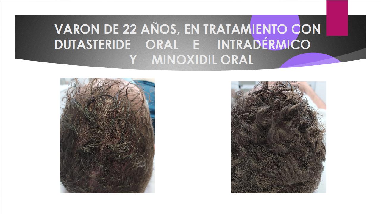 DERMABIA - Mesoterapia capilar con microinyecciones de Dutasteride