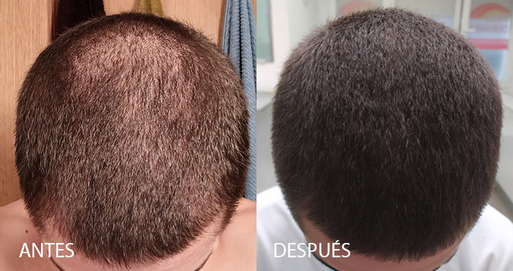 DERMABIA - Mesoterapia capilar con microinyecciones de Dutasteride